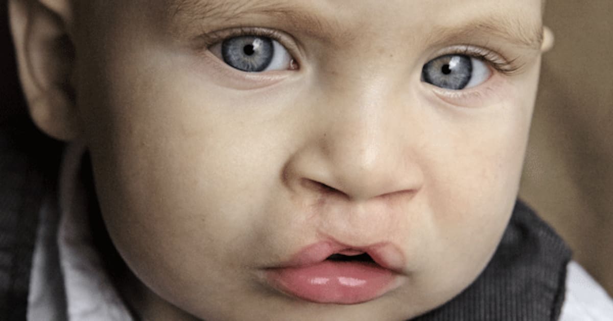 Wat is een schisis (hazenlip) bij je baby?